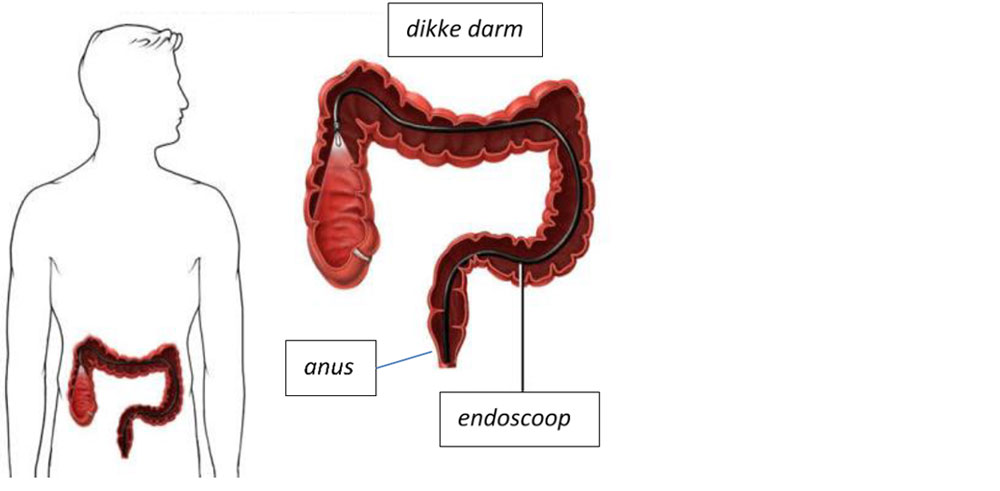 Colonoscopie - voorbereiding met Pleinvue